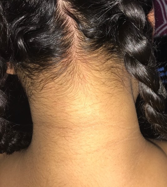 Bye-Bye Dark Spots – all Platts now